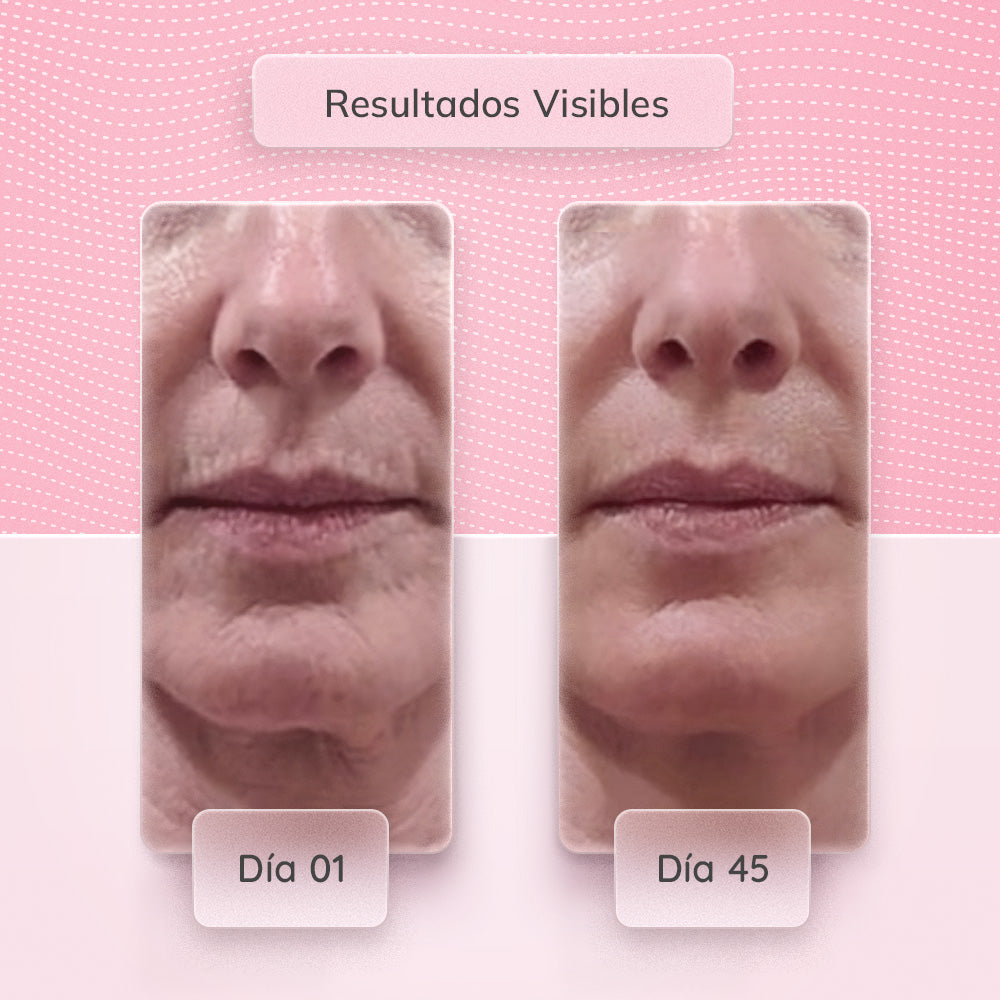 Dispositivo de Rejuvenecimiento Facial Skindion – skindion
